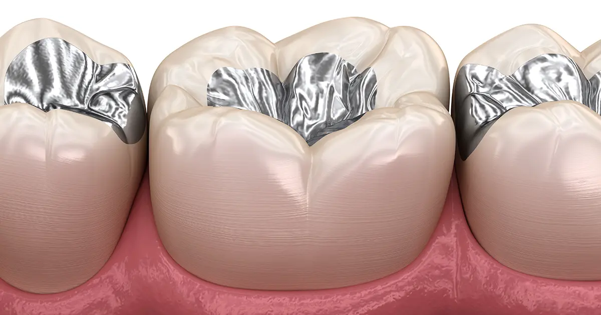 La Unión Europea se prepara para prohibir las amalgamas dentales tóxicas